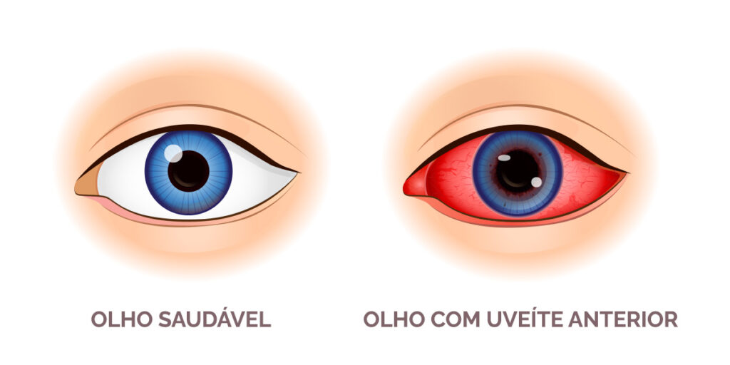 Uveíte: O que é, sintomas e tratamentos - Dra. Camila Otani